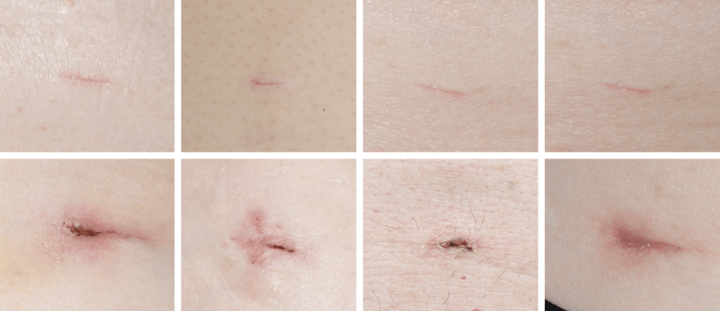 Met MicroMed heb je een perfect alternatief voor hechtingen